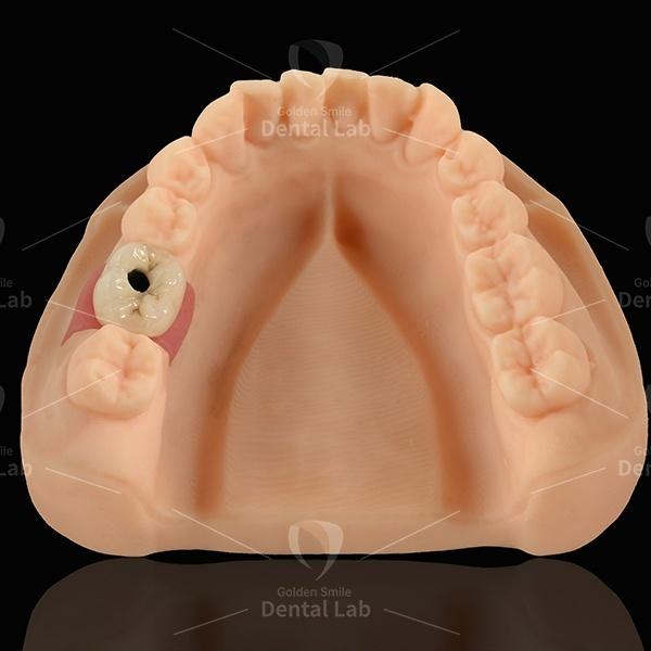 Quality PFM Dental Implant Bridge Co-Cr Screw Retained Bridge CAD CAM Designed for sale