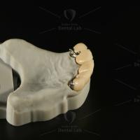 China Precision Ball Attachment Removable Partial Denture China Dental Lab for sale