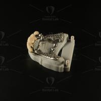 China Precision Ball Attachment Removable Partial Denture China Dental Lab for sale