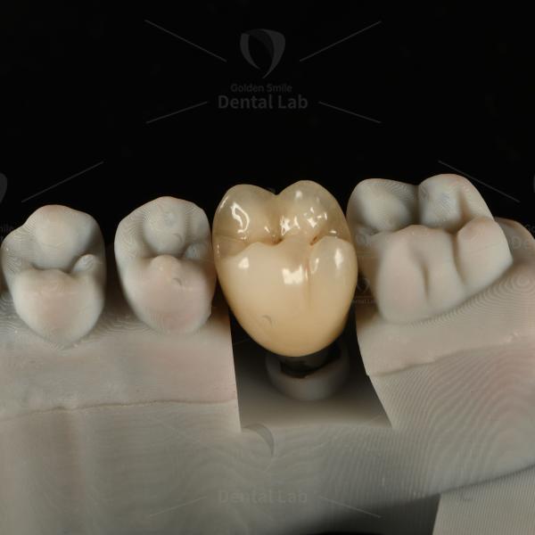 Quality Cement Retained Zirconia Implant Crown And Bridge CAD/CAM Dental Lab for sale