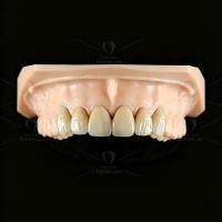 Quality Co-Cr Alloy PFM Crown & Bridge China Dental Lab for sale
