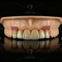 Quality Multilayered Full Zirconia Screw-Retained Bridge, Customizable, for Anterior for sale