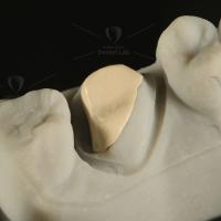 China Cobalt-Chromium Post & Core with Multi-Layer Zirconia Full Crown for sale