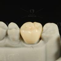 China Cobalt-Chromium Post & Core with Multi-Layer Zirconia Full Crown for sale