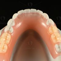 China Full Acrylic Resin Removable Partial Denture for sale