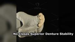 Precision Ball Attachment Dentures No Visible Clasps