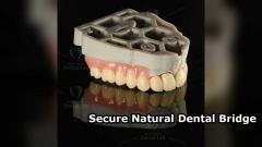 Fixed Removable Dental Bridge with Ball Cap Attachments