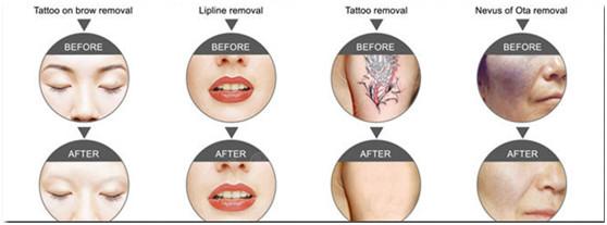 Quality 532nm 1064nm ND:YAG laser tattoo removal machine qmlaser for sale