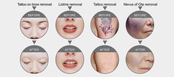 Quality Q-Switched Nd:YAG Laser Tattoo Removal Equipment qmlaser for sale