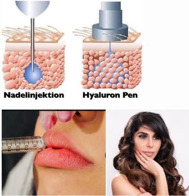 China Adjustable Needle Free Hyaluron Acid Pen 5ml For Lip Filler With Mesotherapy Ampoules for sale