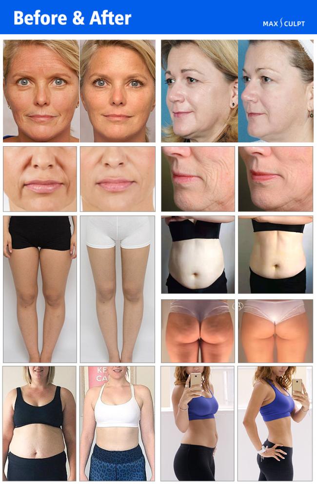 Velabody Slimming Machine RF Fat Reduction Machine Vacuum Weight Loss Machine