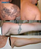 China 2000W Picosecond Laser Tattoo Removal Machine for sale