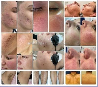Cina M22 IPL Laser Beauty Equipment Nd Yag Tattoo Removal and Hair Removal Macchina di ringiovanimento della pelle per lo scolorimento della pelle in vendita