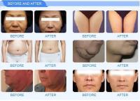 China Anti Aging Face Wrinkle Removal Machine for sale