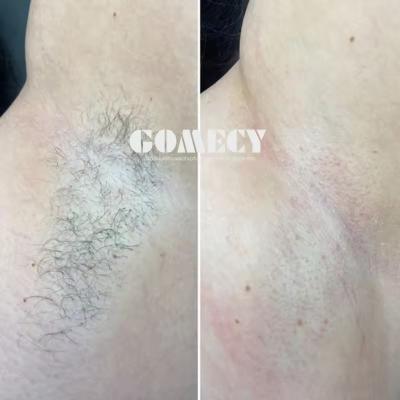 China Germany Triple Wavelength Diode Laser Hair Removal Machine 4 Wave 808 755 940 1064nm Diode Ice 2in1 Diode Laser Hair Removal Machine for sale