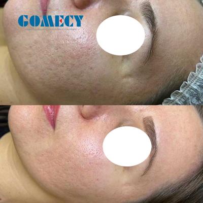 Cina 5mm Spot Size Q-switched Nd Yag Laser 755nm Picolaser con raffreddamento ad aria e acqua in vendita