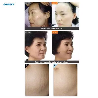 China Fractional Microneedling Radio Frequency Machine for Pore Minimizing Skin Smoothing and Lifting for sale