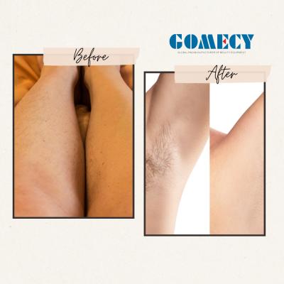 China GOMECY 2024 Ai Skin Analysis Hair Removal Diode Laser Machine Ice Titanium 4 Waves 755 808 1064nm for sale