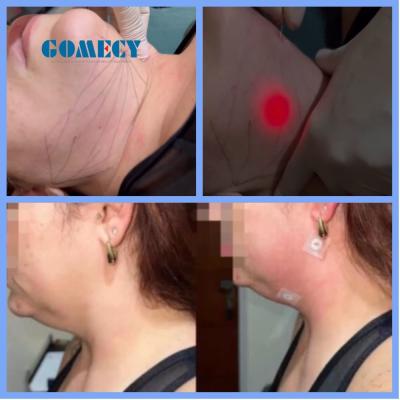 중국 거미 정맥/얼굴 정맥 제거 및 지방 용해/지방 흡입 지방 융해를 위한 엔도리프트 레이저 기기 펄스 지속 시간 0-999초 판매용