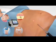 980nm lichaamsslankmachine met laservetzuigmachine Endolift Double Chin Removal Machine
