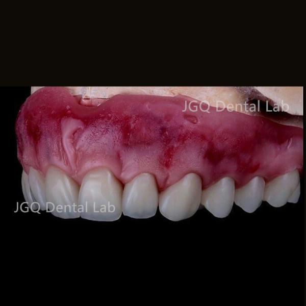 Quality 3D Printer Zirconia Crown and Bridge Hybrid Dental Implant with Titanium Abutment for sale