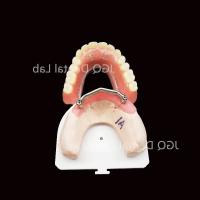 Quality Customized Hybrid Dental Implants Hybrid Denture With Titanium Bar for sale