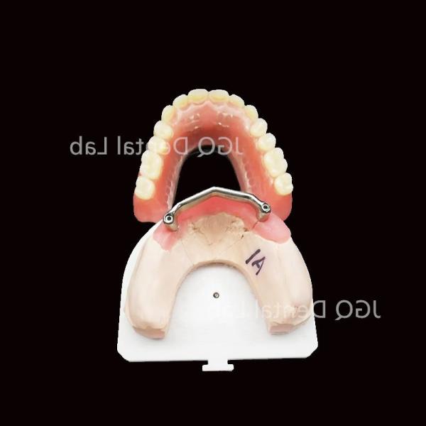 Quality Customized Hybrid Dental Implants Hybrid Denture With Titanium Bar for sale
