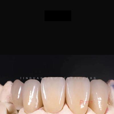 China Customized High-Quality Zirconia Dentures Crafted with Precision for Superior Durability and Aesthetic Appeal From Jgq Dental Lab for sale