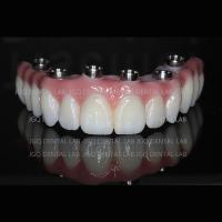 Quality Titanium Abutments Dental Implant Screw Retained Crown For Dental Restoration for sale