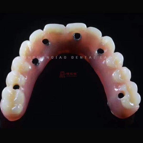 Quality Snap in Implant Dentures Hybrid Dental Implant Restoration Screwed Retention for Dental Lab for sale