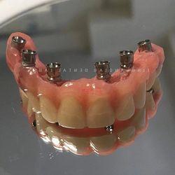 China Choose China Dental Implants for Permanent and Reliable Solution to Missing Teeth with Wholesale Prices for sale