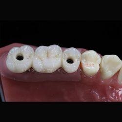 China Customized Implant Teeth Bridge Implanting Guide Look Like Natural Teeth Restore Oral Health, Function and Appearance for sale