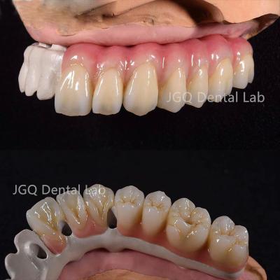 China All On 6 Dental Implants Fixed Dentures Dental Lab All Ceramic FDA CE Certificated for sale