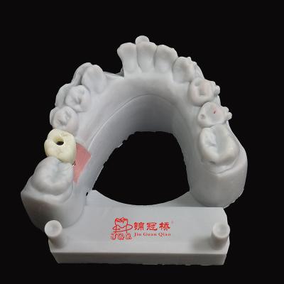 China Customized Screw Retained Dental Implants with Titanium Base and 3D Laser Printing Monolayer Zirconia Dentures for sale