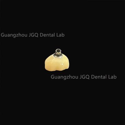 China Customized Titanium Abutment Implanted Dentures for Durable Dental Solutions for sale