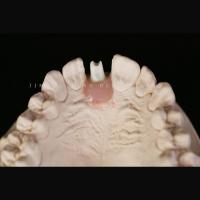 Quality Dental Implant Restorations Custom Titanium Zirconia Abutment En China Dental for sale