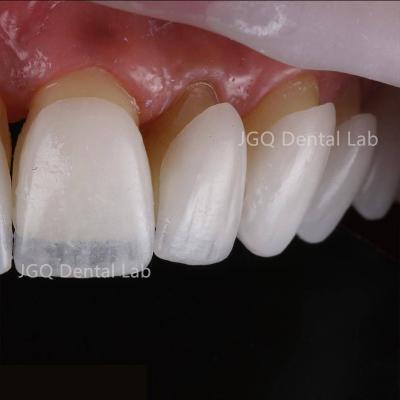 China E.max All Ceramic Dental High Translucency China Dental Lab for sale