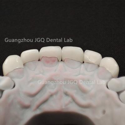 China Customized Dental Laminate Veneers and Zirconia Crown with Fast Turnaround and Biocompatible Materials for sale