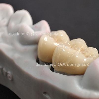 China Fracture Proof Zirconia Structure Durable Posterior Dental Restoration for sale