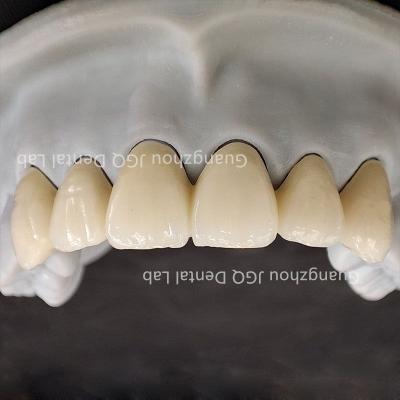 China Natural Translucent Zirconia Restorations Custom Designed For Anterior Teeth for sale