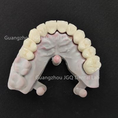 China 3Shape Digital Workflow Zirconia Precise Occlusal Alignment Technology JGQ Dental Lab Custom Zirconia Restoration for sale