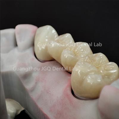 China High Toughness Zirconia For Heavy Occlusion And Bruxism Protection for sale
