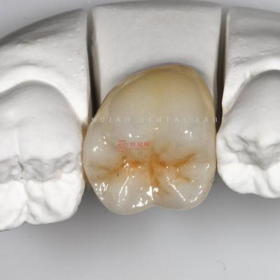 China Medical Grade Dental Zirconia Restoration Precision CNC Milling Customized for sale