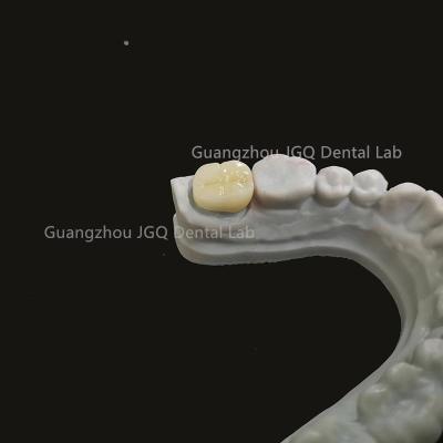 China Custom Zirconia Crown Bridge Certified Dental Lab Full Range Dental Restoration Services for sale