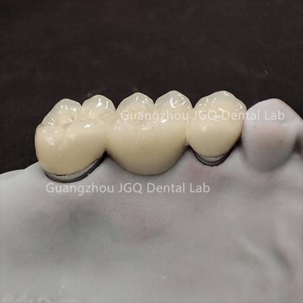 Quality Custom China Dental Laboratory Zirconia Crown Bridge for Global Clinics for sale
