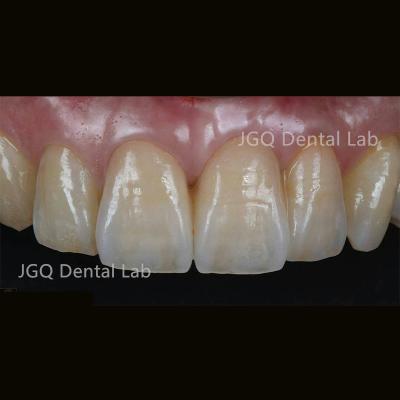 China CNC Milled Esthetic Zirconia Crown Bridge High Precision Fast Shipping for sale