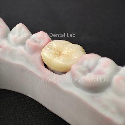 China Natural Looking Layered Zirconia Restoration High Durability Dental Lab Fast Production for sale