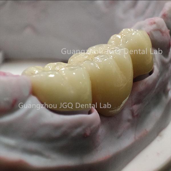 Quality High Quality Monolithic Zirconia  Smooth Surface Precise Margin Fit for sale