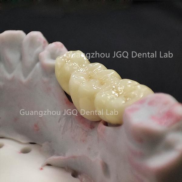 Quality High Quality Monolithic Zirconia Smooth Surface Precise Margin Fit for sale