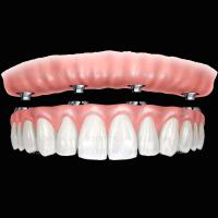 Quality Full Mouth Dental Implant Bridge Customized Implanting Guide For Oral Restoratio for sale